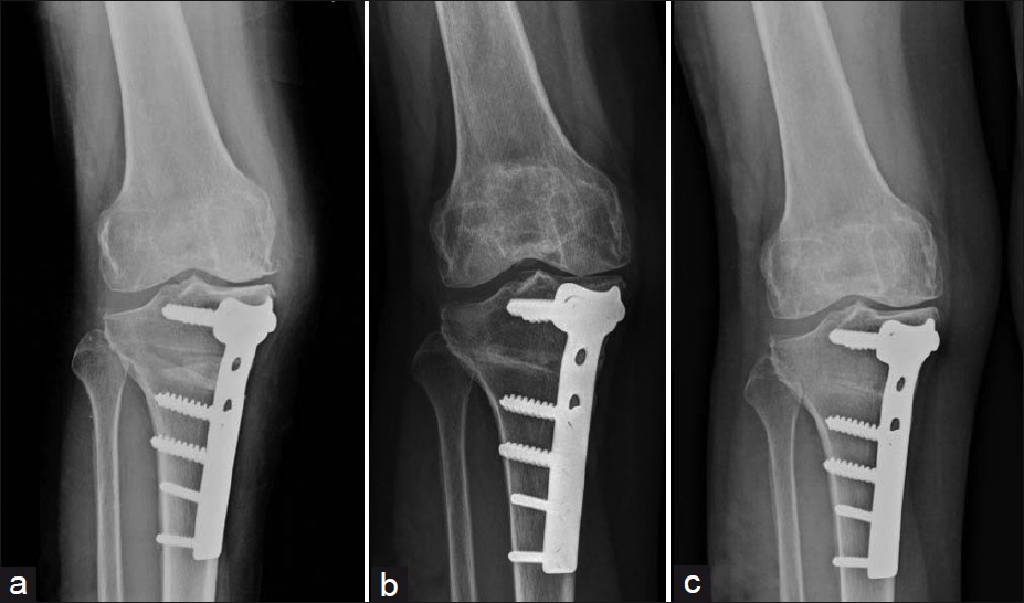 High Tibial Osteotomy in New BEL Road